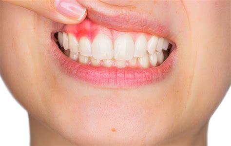 What Are The Most Common Dental Implant Infection Signs
