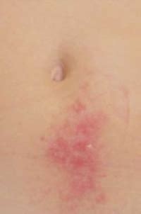 Periumbilical Flare