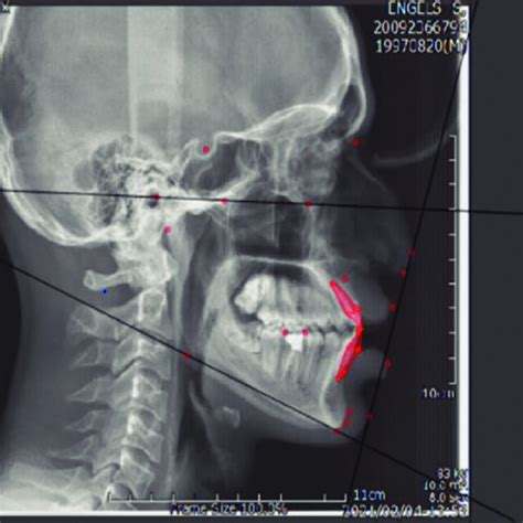 Semi Automated Cephalometric Tracing Using Facad Software Download