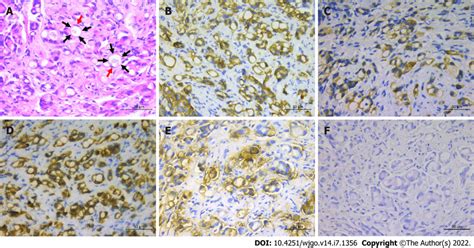 Primary Signet Ring Cell Carcinoma Of The Extrahepatic Bile Duct A