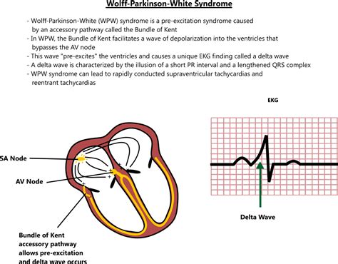 Wolff Parkinson White Syndrome Illustration Erofound