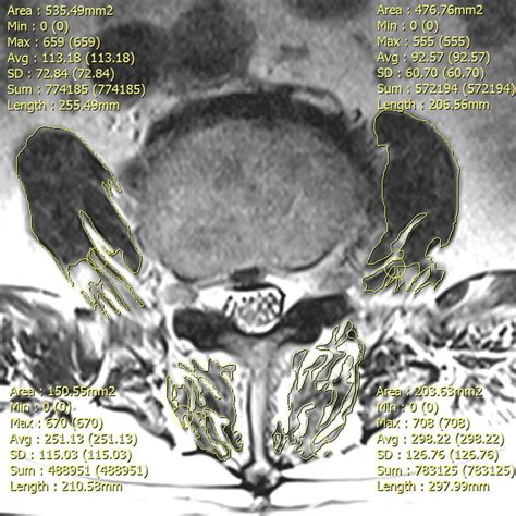 Measurement Of Cross Sectional Area Csa Of Bilateral Psoas Ps And