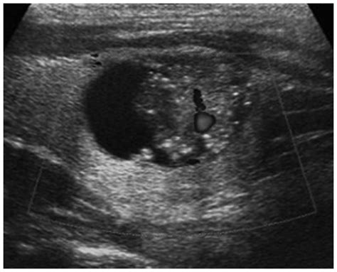 Thyroid Cancer Ultrasound