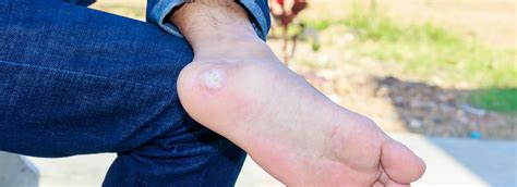 Corns On The Foot Foot Doctor