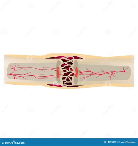 2 Stage Of Healing Bone Fracture Formation Of Callus The Bone