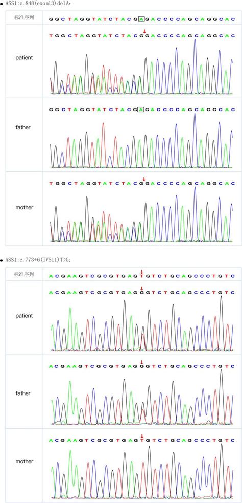 sanger sequence of ass1 c 848 dela and c 773 6t g from patient 1