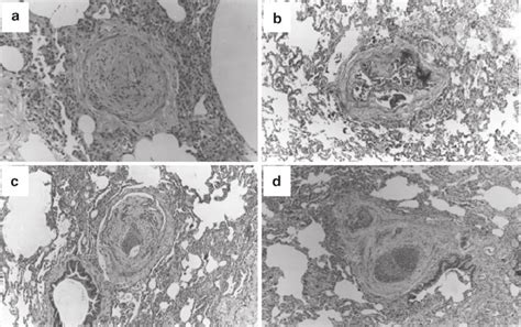 A Prominent Medial Hypertrophy With Intimal Fibrosis Resulted In Download Scientific Diagram