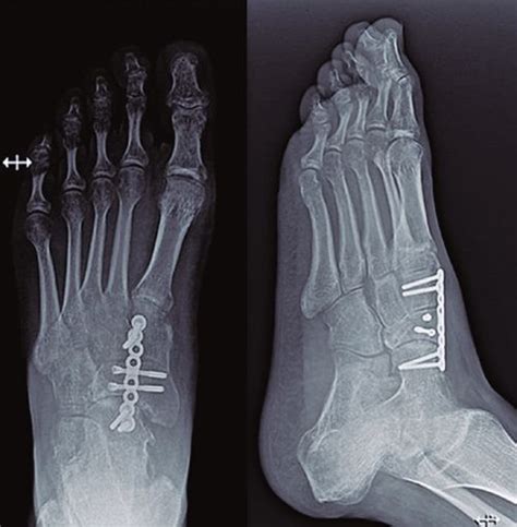 Comminuted Navicular Fracture Treated With An Internal Fixation Plate