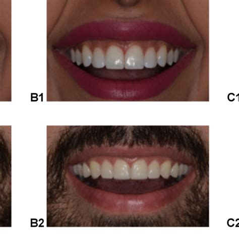 The 1 St Set Of Images With A Different Order Of The Proximal Contact