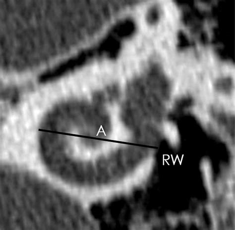 Imaging For Cochlear Implantation Structuring A Clinically Relevant Report Clinical Radiology