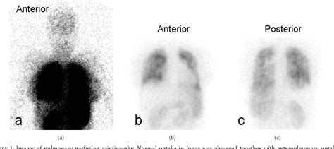 Figure 1 From A Case Of Aortopulmonary Window Asymptomatic Until The
