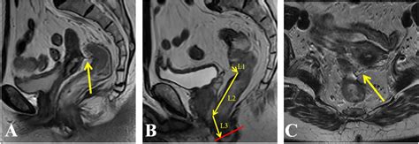 Rectal Tumor