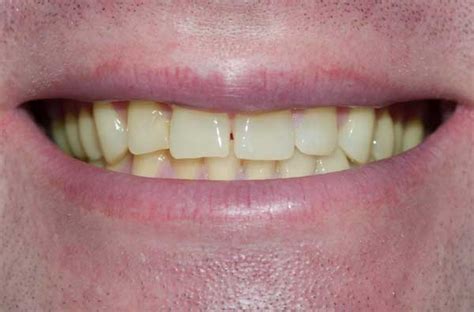 Dental Before And After Photos In Tinley Park