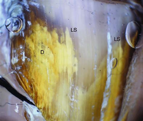 Dermoscopic Features Of Distal Subungual Onychomycosis D Indicates Download Scientific
