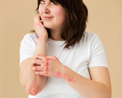 Say Goodbye To Seborrheic Dermatitis Effective Anti Inflammatory Trea Purclarity Skincare