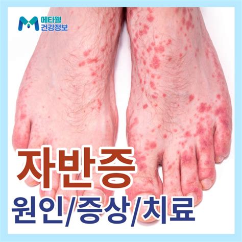 성인 자반증 증상 색소성 자반증 원인 혈관염 검사 치료 총정리 네이버 블로그