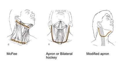 Neck Dissection Head Neck Oncosurgerypptx Death Injury Or Military