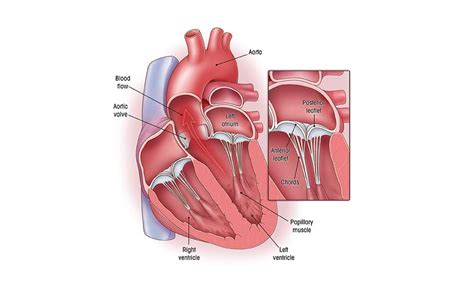 Minimally Invasive Mitral Valve Repair