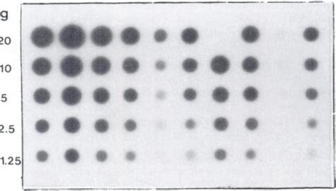 Dot Blot Analysis Of Total Rna From 10 Primary Breast Cancers Showing