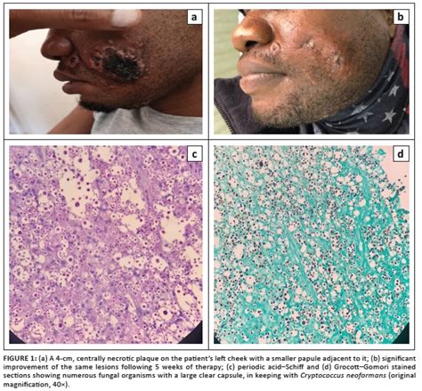 Cutaneous Lesions In The Setting Of Disseminated Cryptococcus