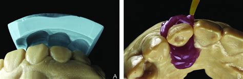 A Silicone Putty Positioning Index B Interim Crown Replica Seated On