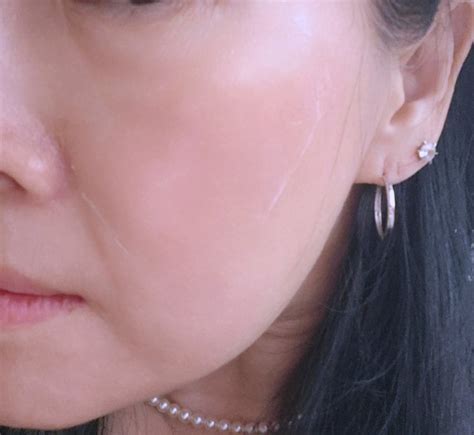 투명썬패치 프란츠 티 안남 홈쇼핑 후기 붙이는 방법 주의 내돈내산 네이버 블로그
