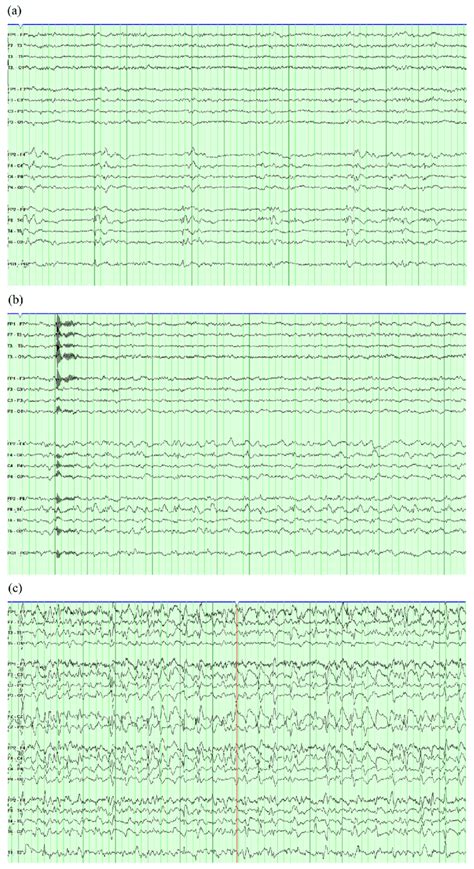 EEG Examples Of Patterns On The Ictal Interictal Continuum From The Download Scientific Diagram