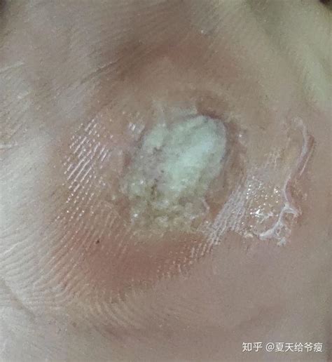 伤口一直不愈合一碰水就泡白 知乎