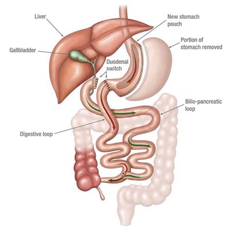 Duodenal Switch My Doctor Click