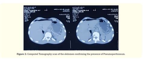 Pneumoperitoneum Laparotomy Oman Peritonealcavity Geneticpathologies… Sushmita Sahoo