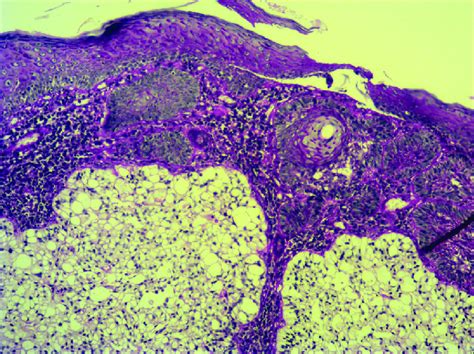 Case 1 Negative Staining Of The Clear Cell Population With Periodic
