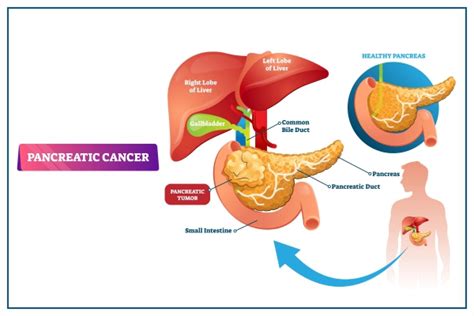 Pancreatic Cancer Symptoms Causes Risks And Diagnosis
