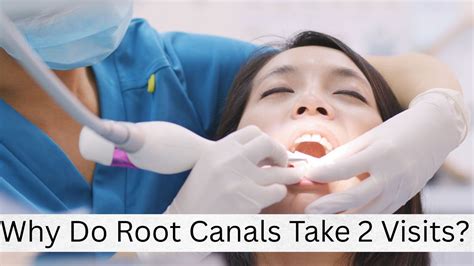 Why Do Root Canals Take 2 Visits The Dental Healers
