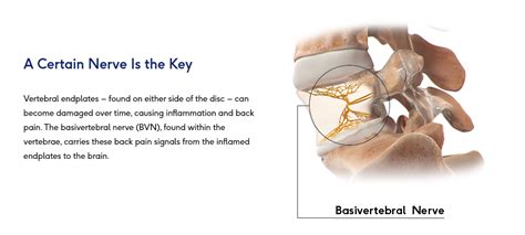 Learn About The Intracept Procedure In Lancaster California