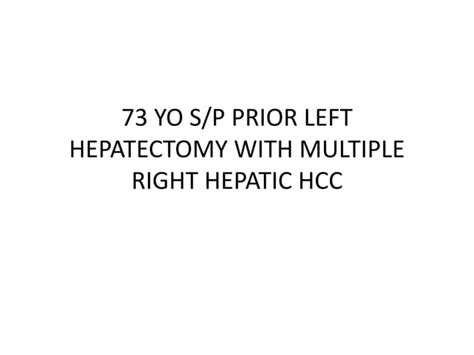 Radioembolization Induced Liver Disease A Brief And Limited
