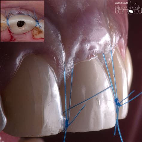 Periodontology Implantology Master Class Tunneling Academy
