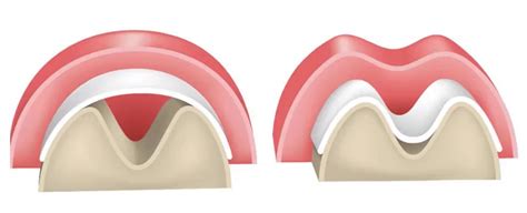 Guided Bone Regeneration Gbr Membrane Part I