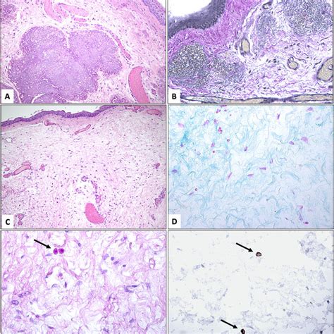 Pdf Conjunctival Myxoma Masquerading As Conjunctival Lymphoma A Case