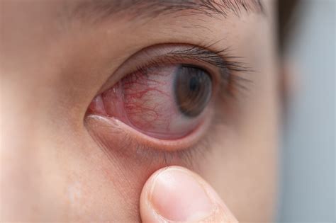 What Does Herpes Look Like Pictures Treatment And Prevention🌛 Sinta