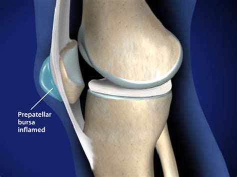 Video Prepatellar Bursitis Kneecap Bursitis Healthclips Online