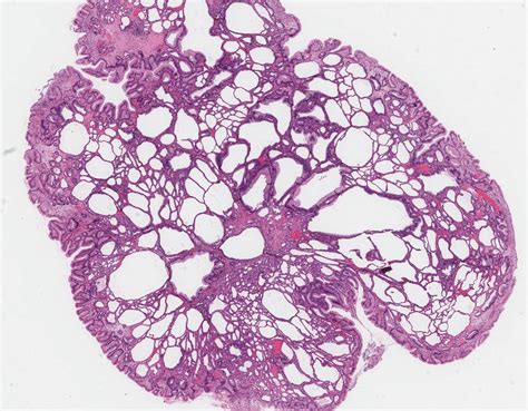 Your Pathology Report For Inflammatory Polyp Of The Stomach