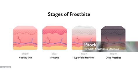 동상 해부학 인포그래픽 포스터 벡터 평면 의료 그림입니다 저체온증 질환의 단계 건강한 서리 박하 피상적이고 깊은 피부층 단계