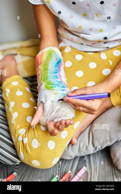 Teen Girl With A Broken Arm At Home Draws An Orthopedic Cast Casted