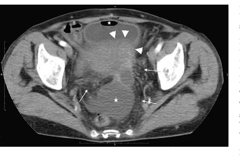 Figure 2 From Colovesical Fistula In Sigmoid Diverticulitis Semantic