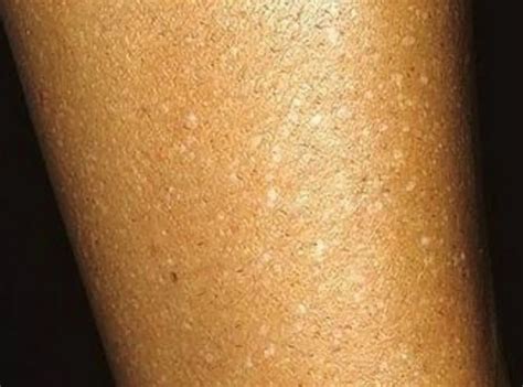 Have You Noticed Small White Spots On Your Arms Or Legs And You Dont