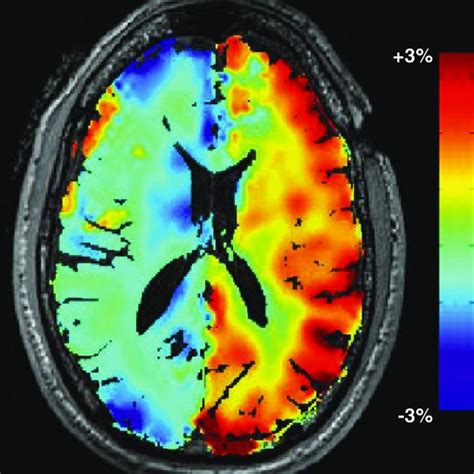 Example Of Intraoperative Bold Cvr Color Coded Map Intraoperative