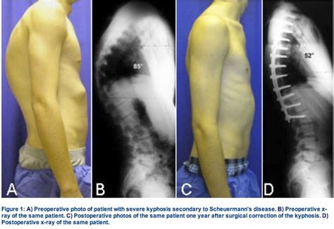 Kyphosis Prof Youssry Elhawary