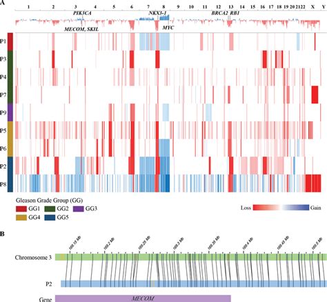 Copy Number Variations Of Prostate Cancer Tissue Sample A Copy Number