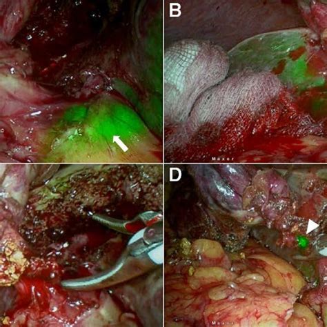 A Icgf After Antegrade Dissection Of Gallbladder Arrow Showing Cbd Download Scientific