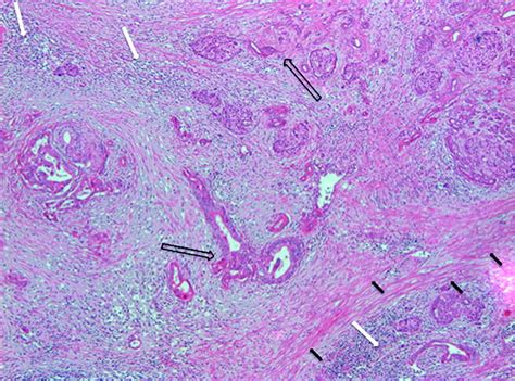 Pancreatic Cancer Pancreatic Ductal Adenocarcinoma Cta